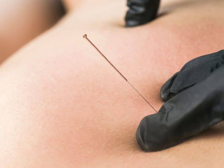 Dry Needling | Next Level Physical Therapy