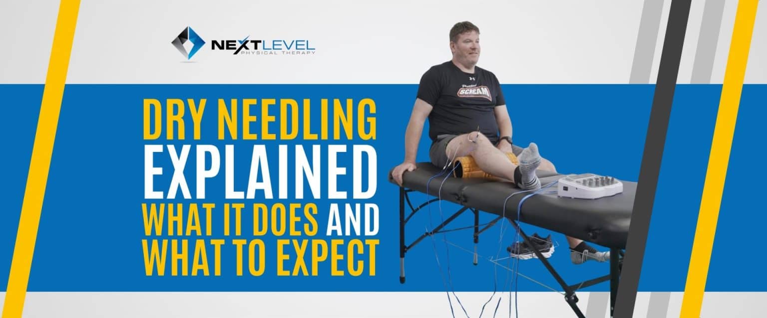 Dry Needling Explained: What It Does and What to Expect | Next Level ...