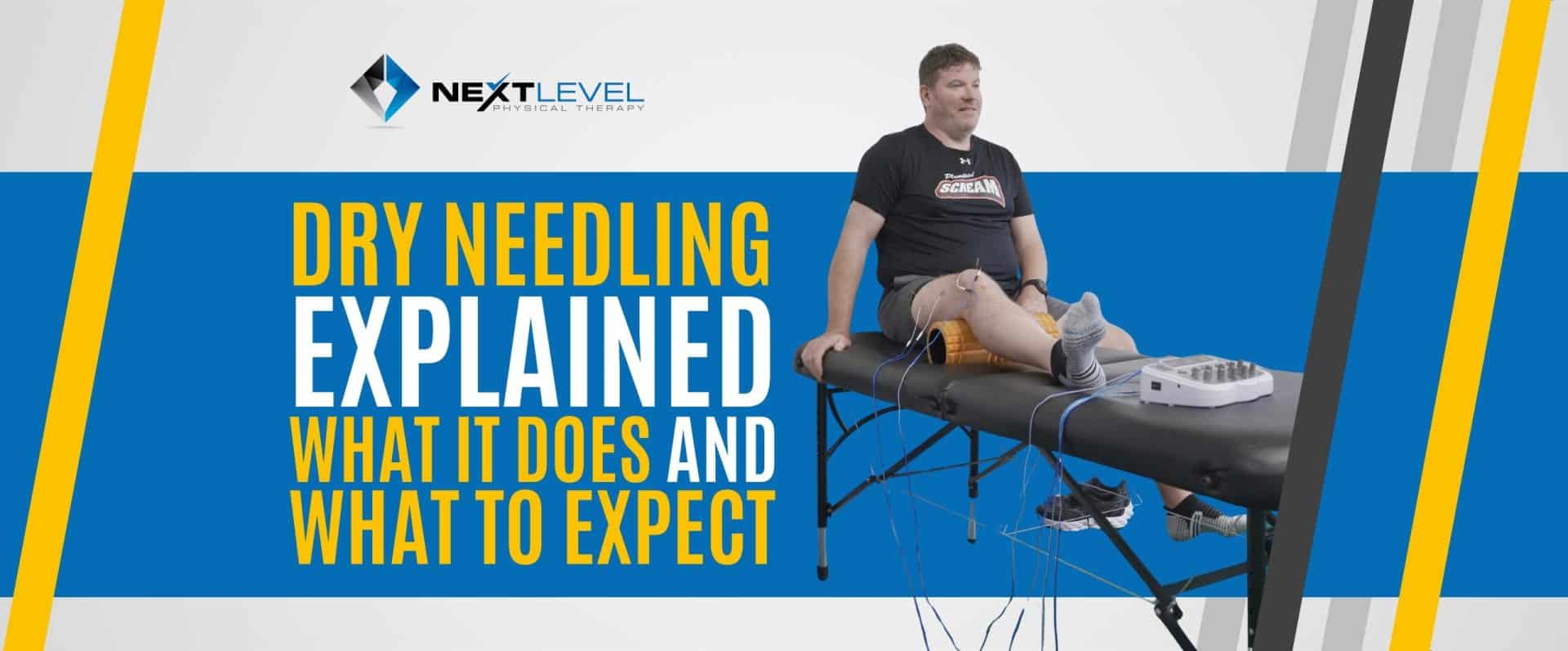 Dry Needling Explained: What It Does and What to Expect | Next Level ...