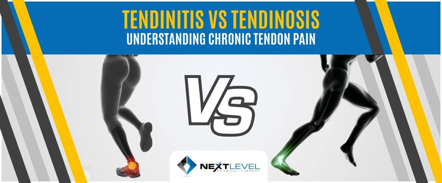 What Is Tendinitis vs Tendinosis? Understanding Chronic Tendon Pain ...